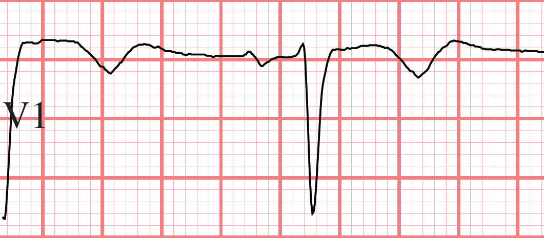 Teaching Medicine - Tutorial: Bundle Branch Blocks